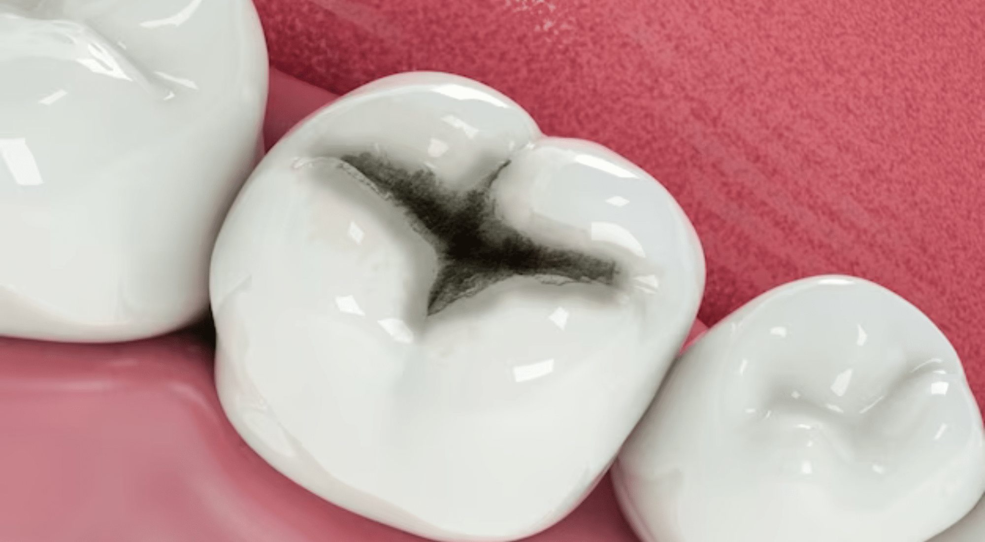 Carie Dentaire : De la Formation à la Prévention