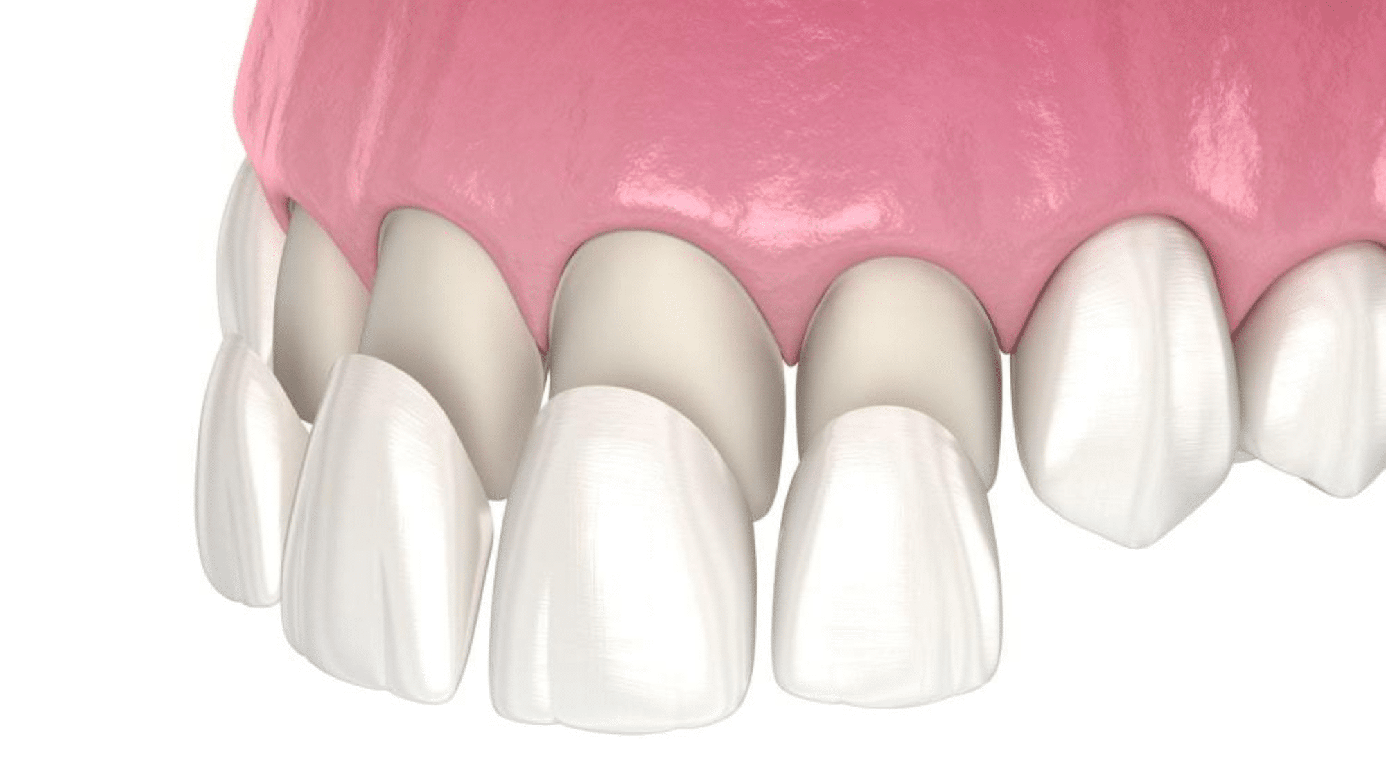 Les Facettes en Céramique Feldspathique - Paris Dental Studios