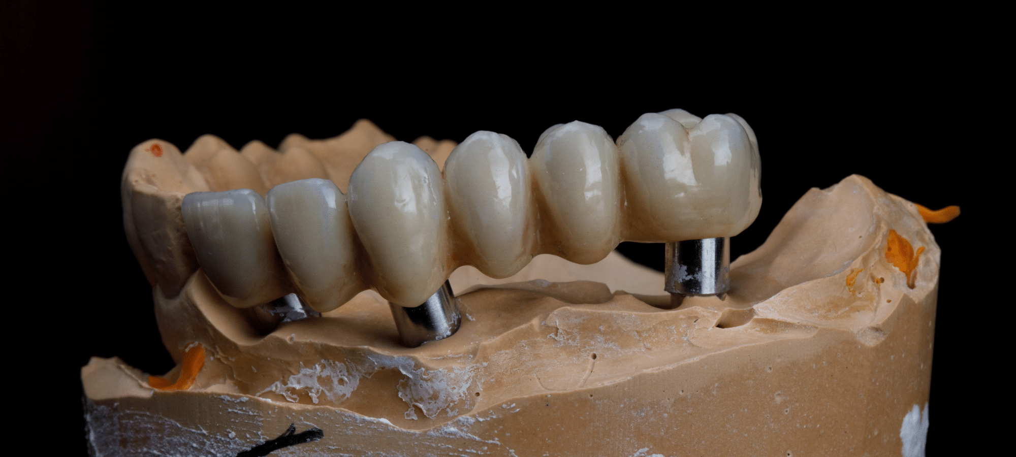 Bridge sur implants dentaires - Paris Dental Studios