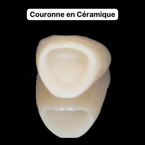 Les Couronnes Dentaires : Tout ce que Vous Devez Savoir - Paris Dental ...