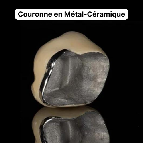 Les Couronnes Dentaires : Tout ce que Vous Devez Savoir - Paris Dental ...